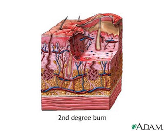 Lila, RN: First Aid 101 - You Got Burned