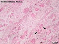 FoFoCaS PaToLoGiCaS: TIPOS DE NECROSE