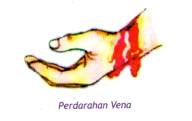 Pertolongan Pertama: PERDARAHAN LUAR