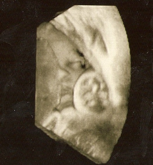 The Williams Family: 31 Week 3D ultrasound