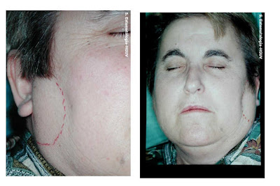 Sialoadenosis