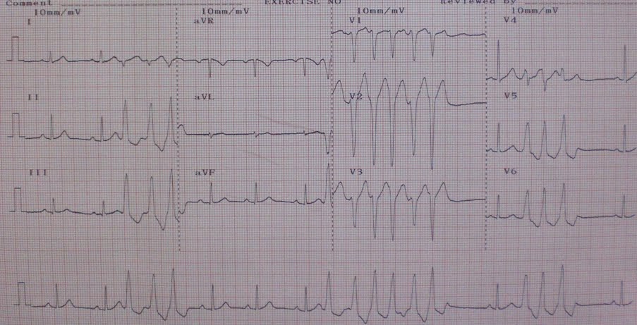 Phimaimedicine: 289. Short run ventricular tachycardia