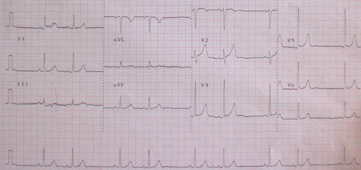 Phimaimedicine: 398. Bigeminal PAC's. or Sinus rhythm with atrial bigeminy