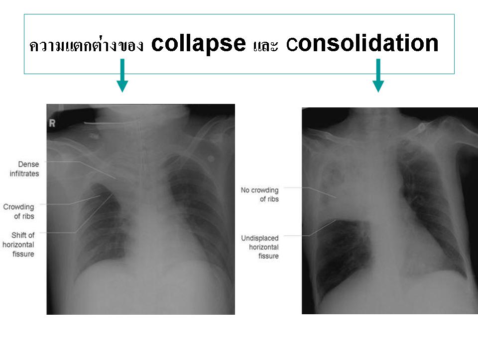 Phimaimedicine: 391. Right upper lobe collapse