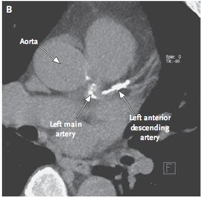 Phimaimedicine: 11. Coronary-artery calcium (CAC) scan