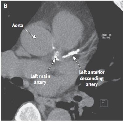 Phimaimedicine: 11. Coronary-artery calcium (CAC) scan