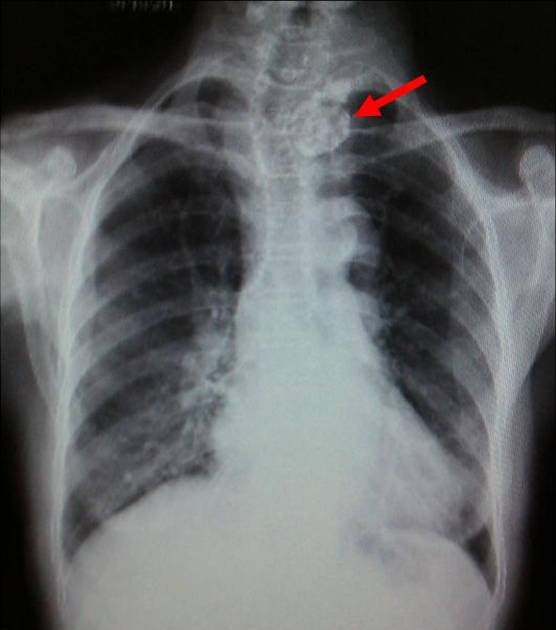 Phimaimedicine 571 Thyroid Calcification Suspect