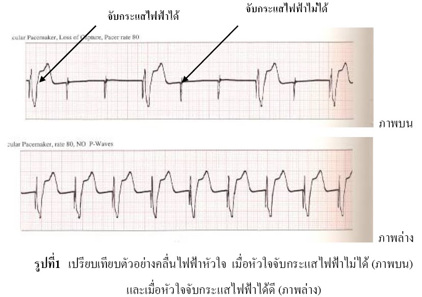 Phimaimedicine: 654. External pacemaker