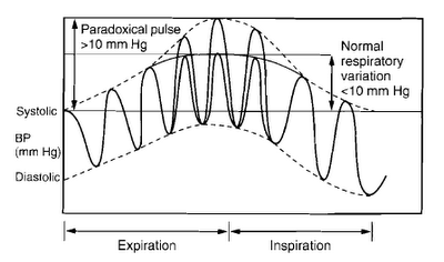 Phimaimedicine: 690. Pulsus paradoxus