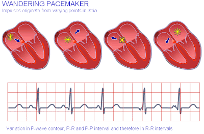 Phimaimedicine: 688. Wandering pacemaker