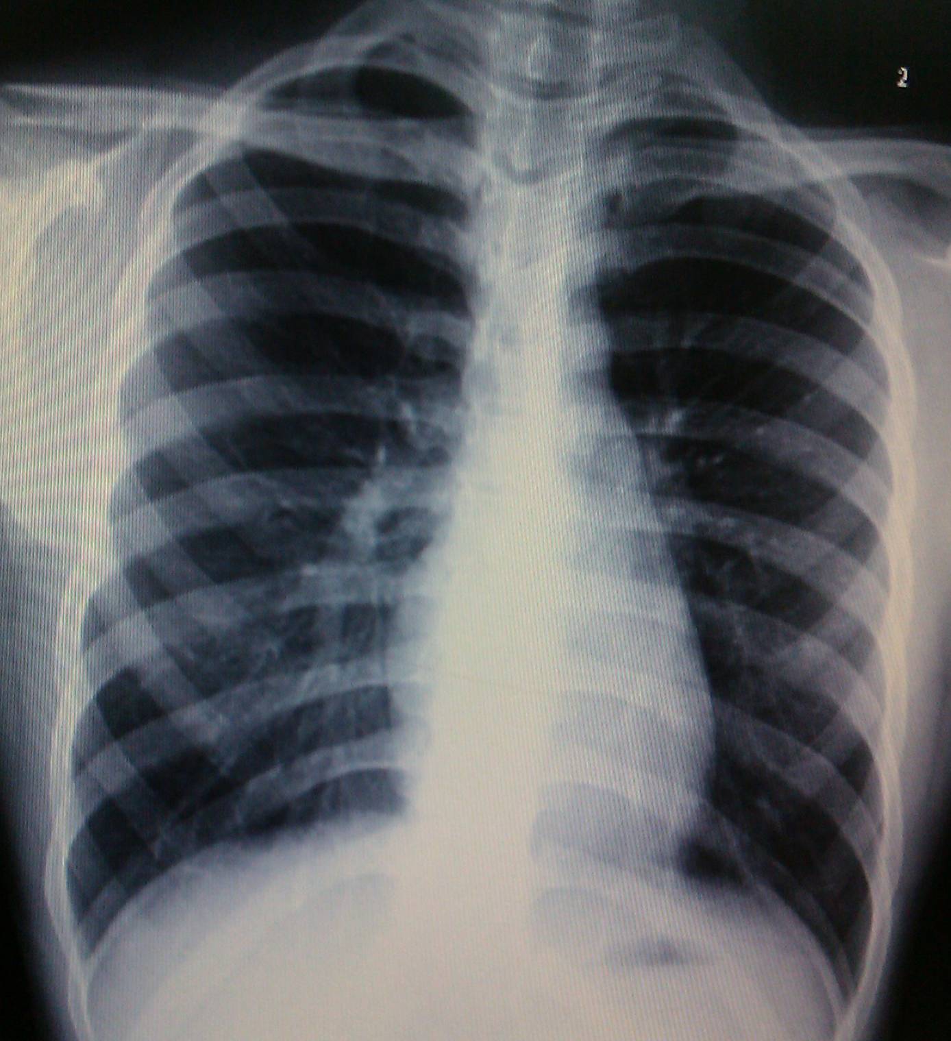 Phimaimedicine: 721. หญิง 19 ปี แข็งแรงดี มาตรวจและ CXR เพื่อเรียนต่อ ...