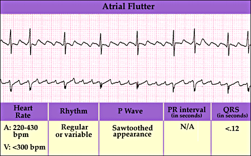 Phimaimedicine 736 Atrial Flutter With Variable Av Conduction Block