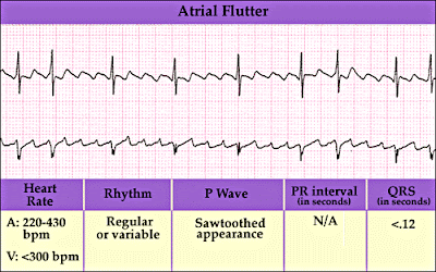 Phimaimedicine: 736. Atrial flutter with variable AV(conduction) block