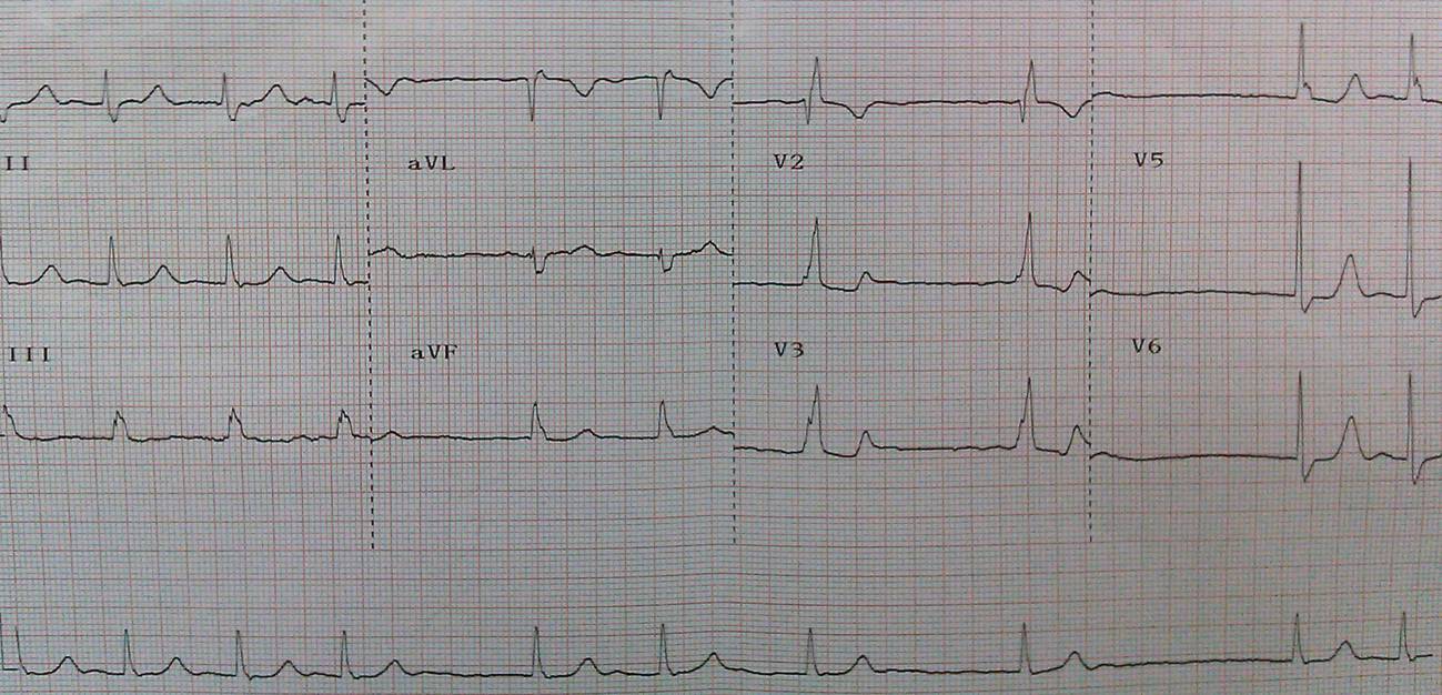 Phimaimedicine: 777. Atrial fibrillation and complete right bundle ...