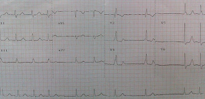 Phimaimedicine: 777. Atrial fibrillation and complete right bundle ...