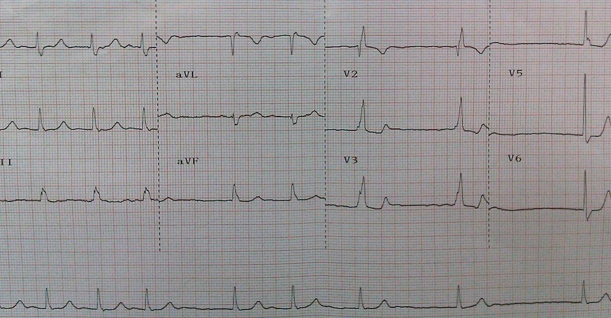 Phimaimedicine: 777. Atrial fibrillation and complete right bundle ...
