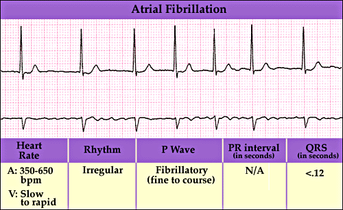 Phimaimedicine: 777. Atrial fibrillation and complete right bundle ...