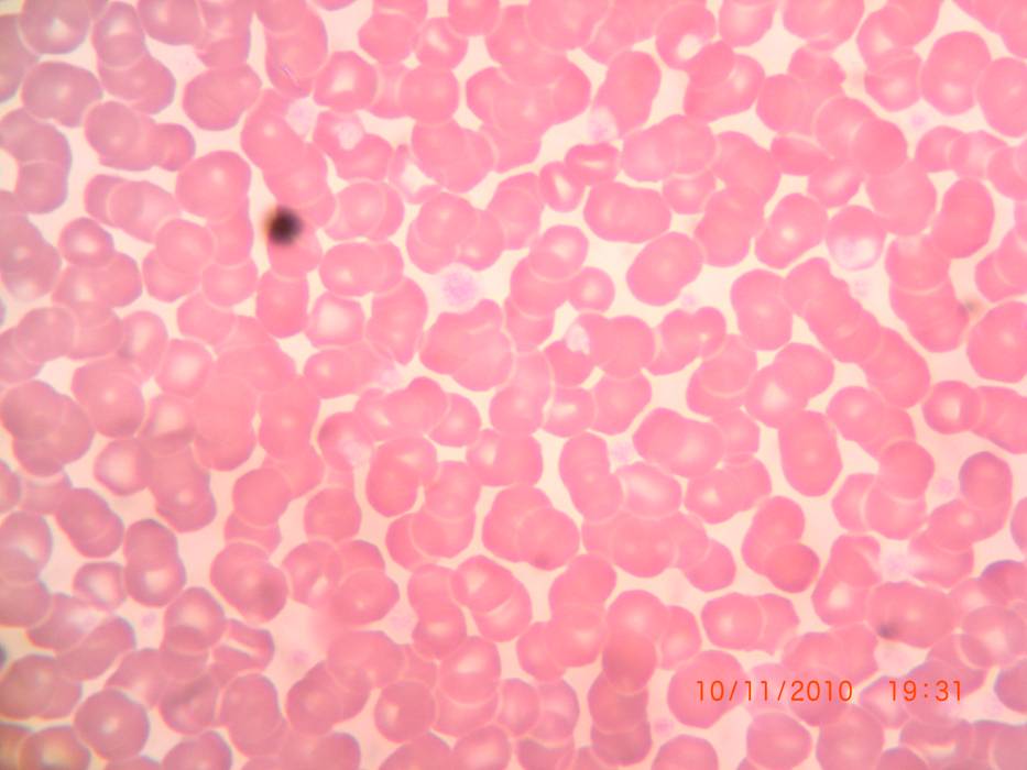 Phimaimedicine: 883. Polycythemia