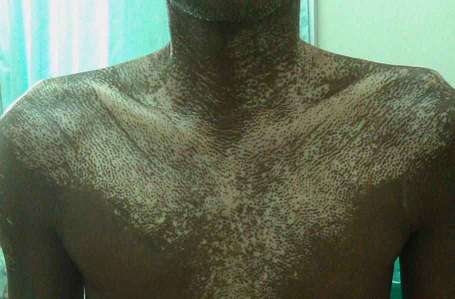 "Salt and Pepper" skin - Scleroderma