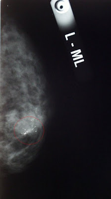 MAMMOGRAPHY: PLEOMORPHIC CALCIFICATION