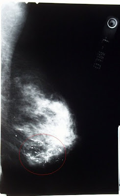 MAMMOGRAPHY: PLEOMORPHIC CALCIFICATION
