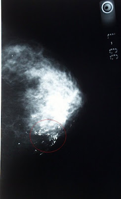 MAMMOGRAPHY: PLEOMORPHIC CALCIFICATION