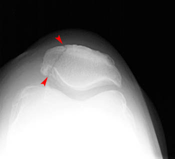 BASIC X-RAY: PATELLAR FRACTURE