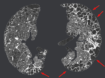 e-CT SCAN: HRCT LUNGS-HONEYCOMBING