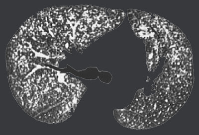 e-CT SCAN: HRCT LUNGS-RANDOMLY DISTRIBUTED NODULES