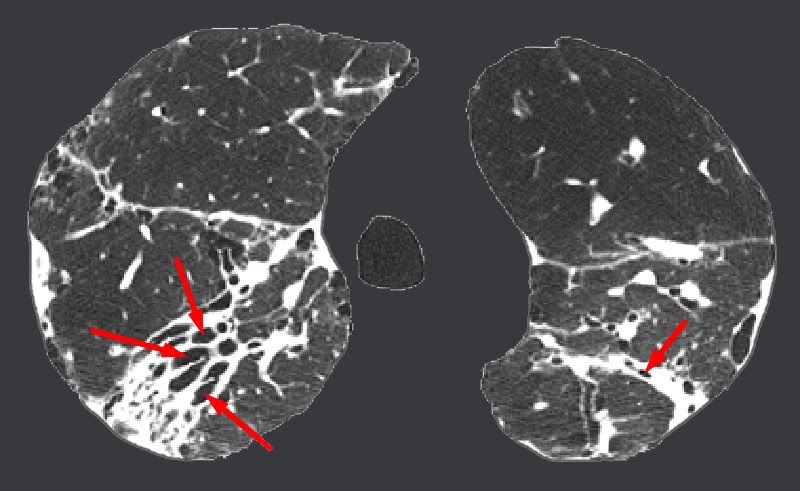 e-CT SCAN: HRCT LUNGS-BRONCHIECTASIS