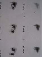 Nuclear Medicine - Another Way Of Learning: HIDA SCAN