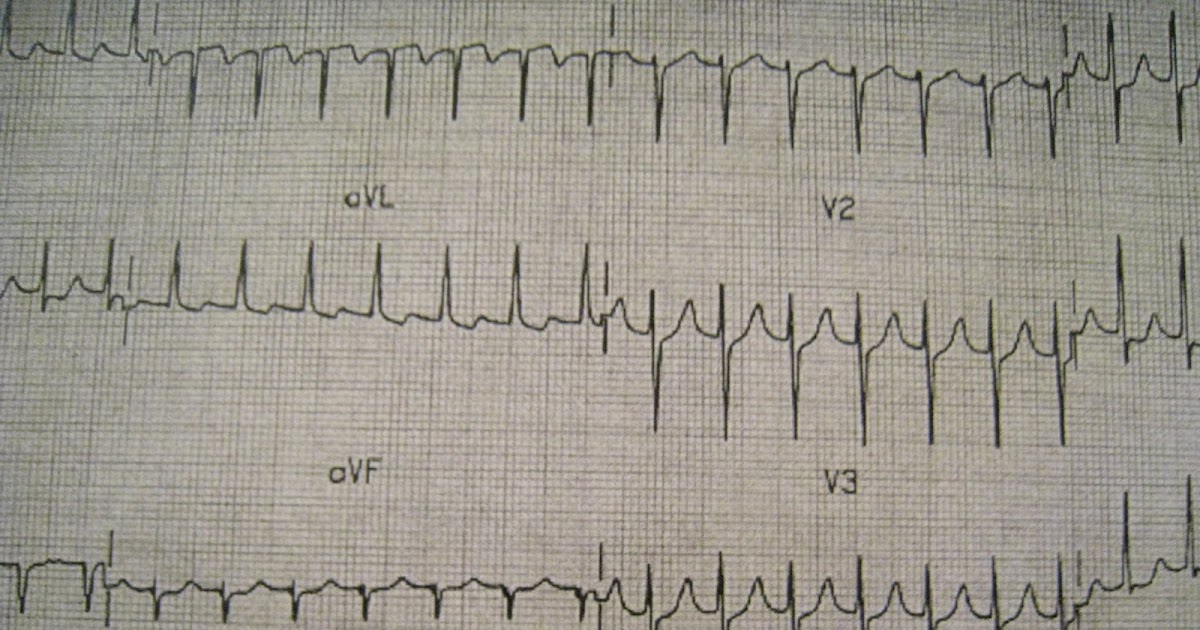 ECG - An Easier Way Of Learning: Fast and regular rhythm strip without ...
