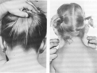 Terra Online: Síndrome de Turner