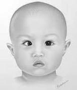 Amblyopia (Lazy Eye) - CHILLAPPLE Group International Health Blog ...