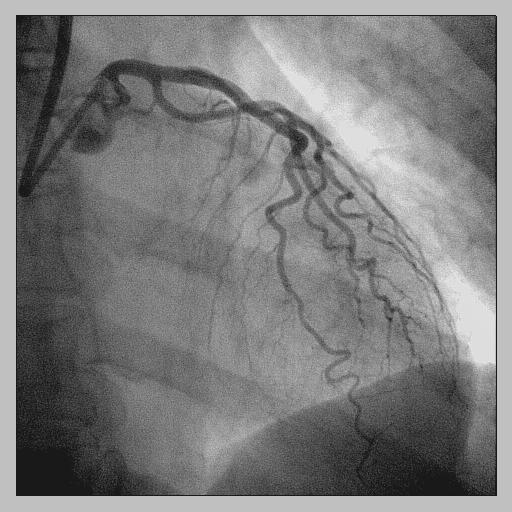 enfermedad cardiovascular: CATETERISMO CARDIACO