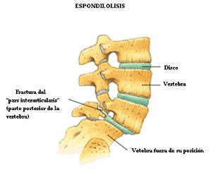 Lumbalgia: Causas del Dolor Lumbar