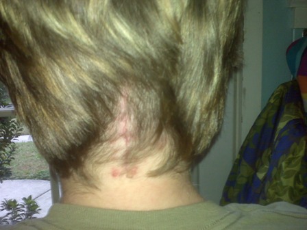 Molly's Brain: Four Weeks Post-Op: Gnarly Scar Pictures!