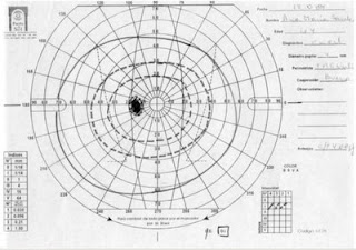 Portafolio Tecnología Médica Oftalmología: (12) Analisis de campos ...