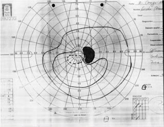 Portafolio Tecnología Médica Oftalmología: (12) Analisis de campos ...
