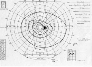 Portafolio Tecnología Médica Oftalmología: (12) Analisis de campos ...