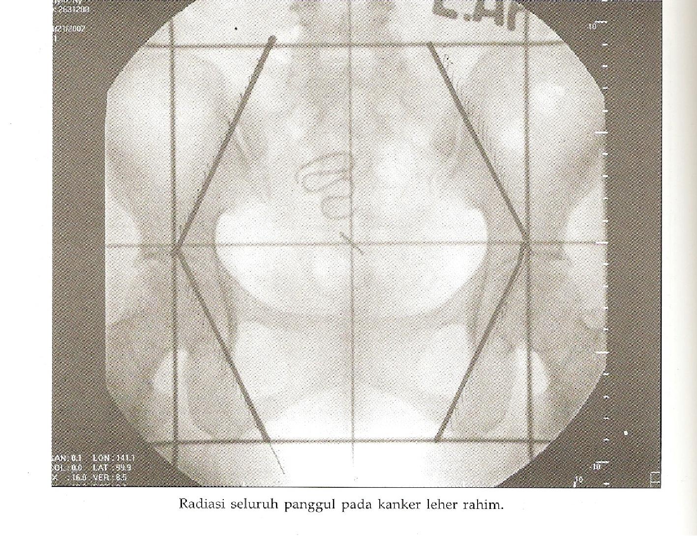 CAKRAWALA: TEKNIK RADIOTERAPI KANKER KANDUNGAN
