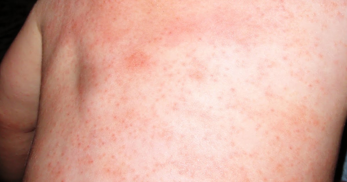 Keeping up with the Kehrlis: mmr vaccine rash