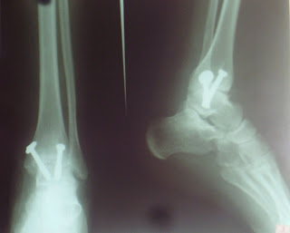 Joint Preservation and Replacement : Arthroscopic ankle fusion