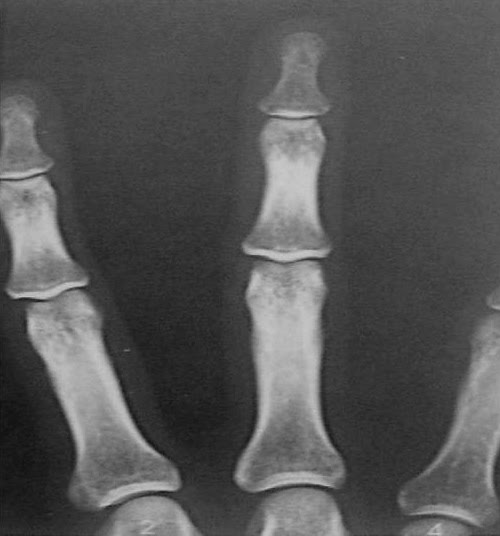 Rayos 2011: Dedos (Segundo a Quinto)