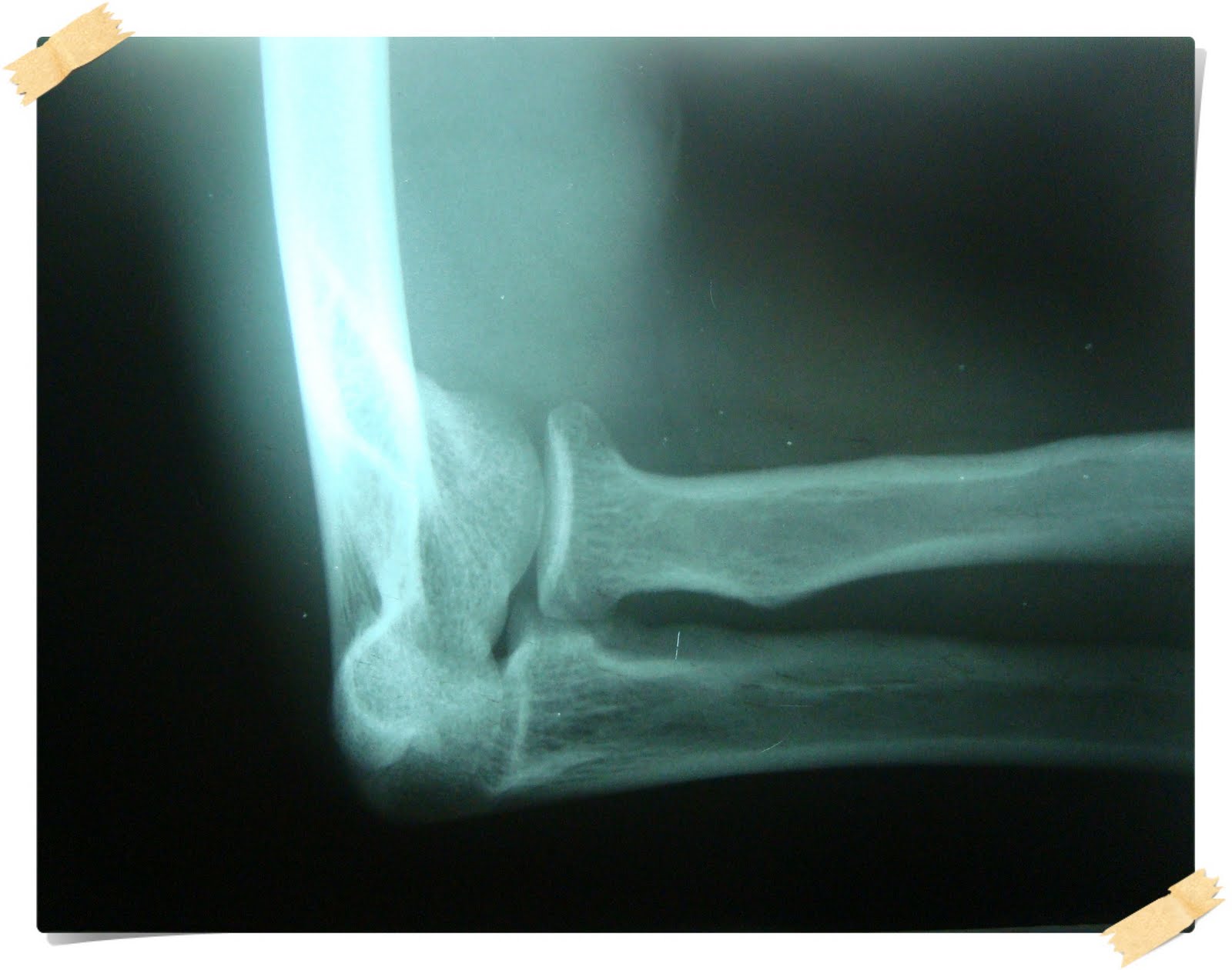 Rayos 2011: Codo