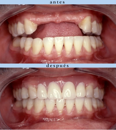 CLINICA DENTAL VALENCIA: * PROTESIS TOTALES Y PARCIALES