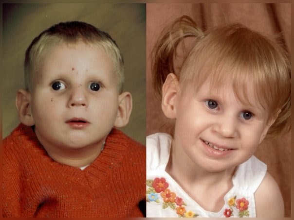 Cockayne Syndrome: CS family in the Book Alphabet Kids