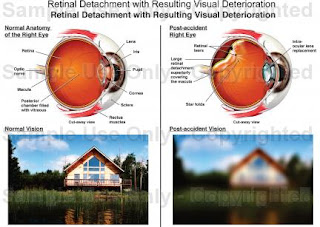 Eye spot 1: Retinal detachment (1)