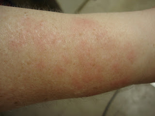 As My Fibro World Turns: Red thick scaly rash photos