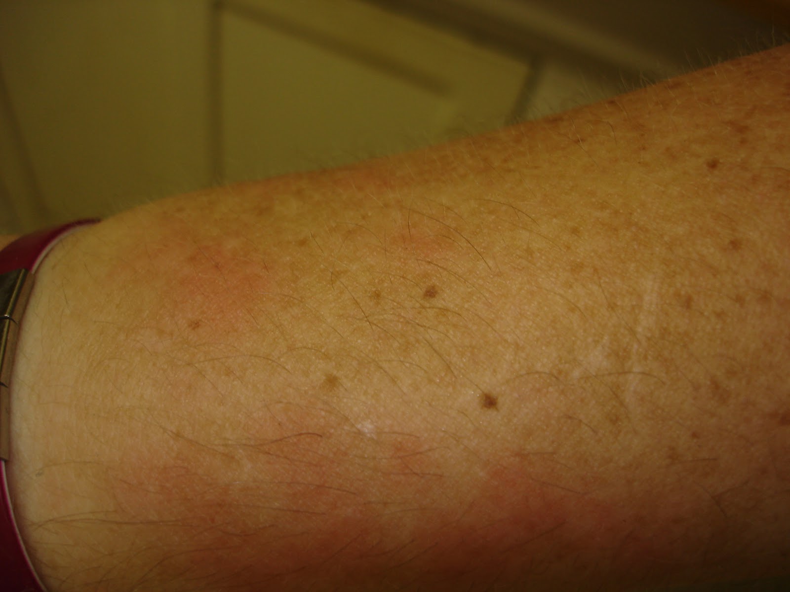 As My Fibro World Turns: Red thick scaly rash photos